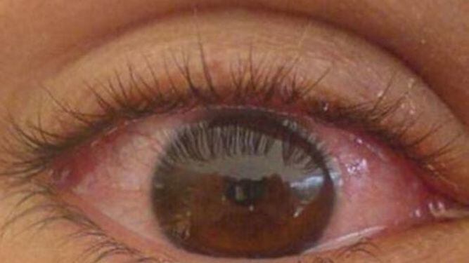 Se Reportan 2 Mil 719 Casos De Conjuntivitis La Prensa Panamá